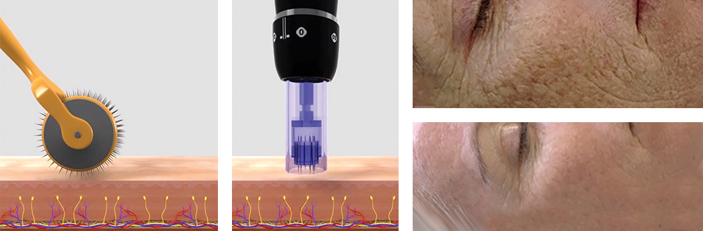 Dermapen Micro Needling - Services - Renew Skin Clinic