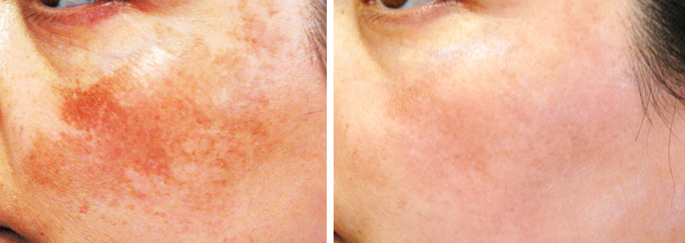 Sun spots, freckles and seborrheic keratosis removal - Services - Renew ...