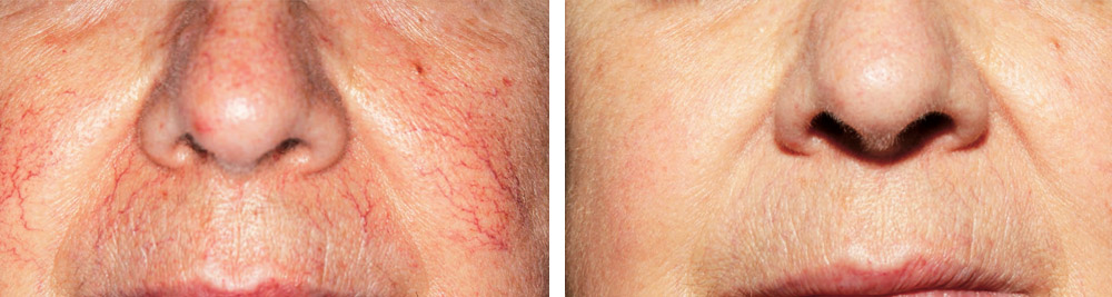 Laser Thread Vein Treatment - Services - Renew Skin Clinic