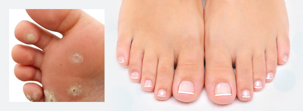 Laser Verruca and Wart Treatment - Services - Renew Skin Clinic