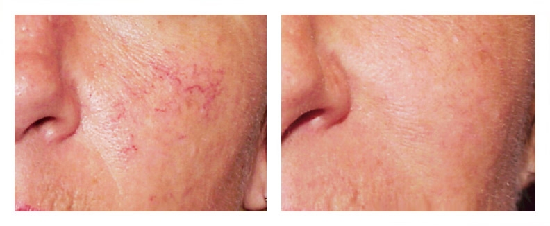 Laser Thread Vein Treatment - Services - Renew Skin Clinic